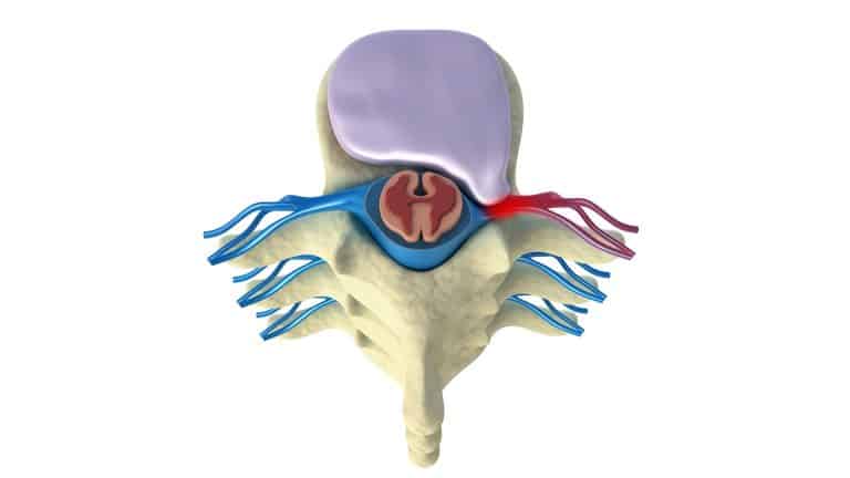 Bulging Disc Symptoms In Your Neck | Spine & Posture Care
